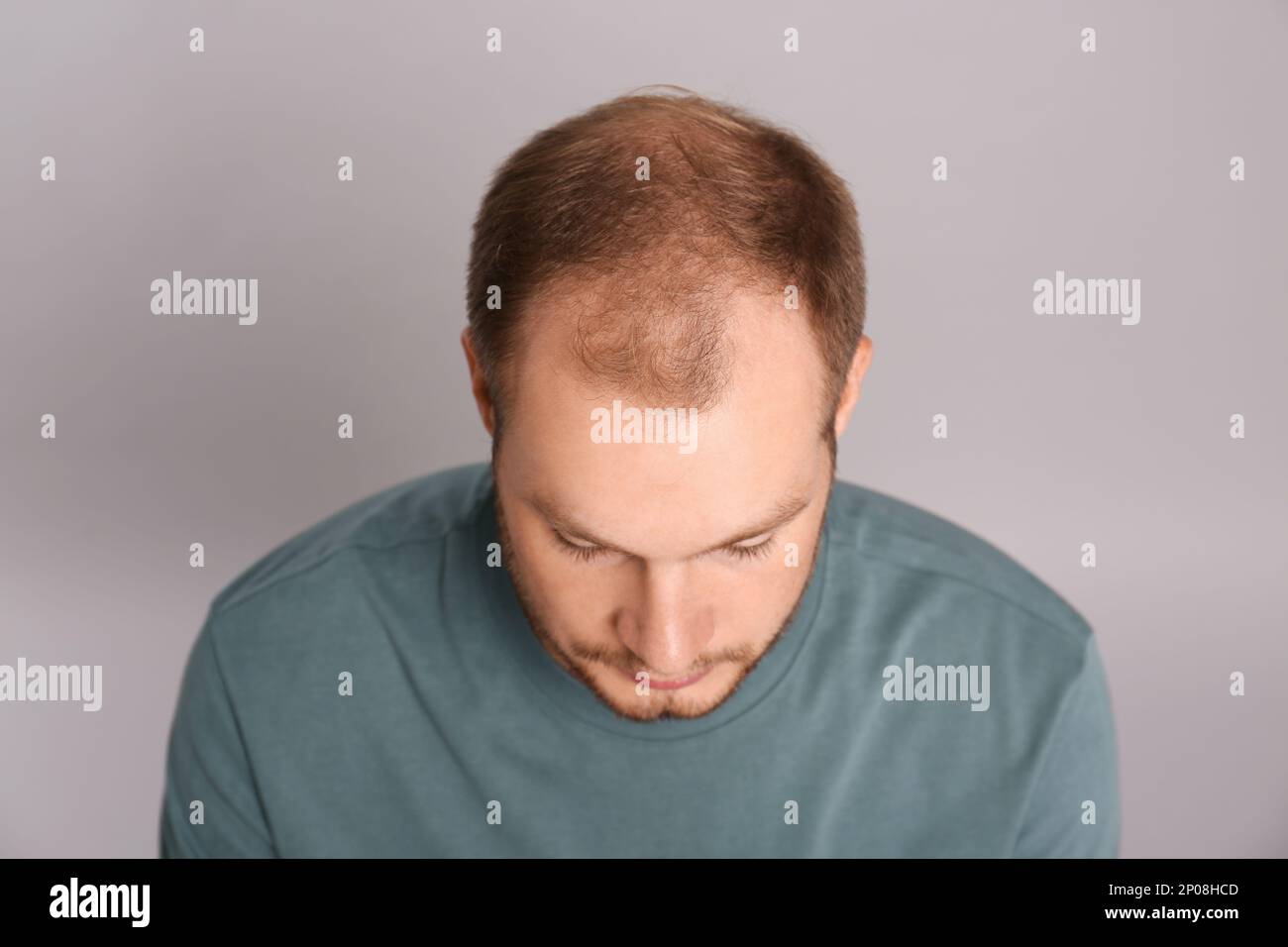 Man with hair loss problem on grey background, above view. Trichology ...