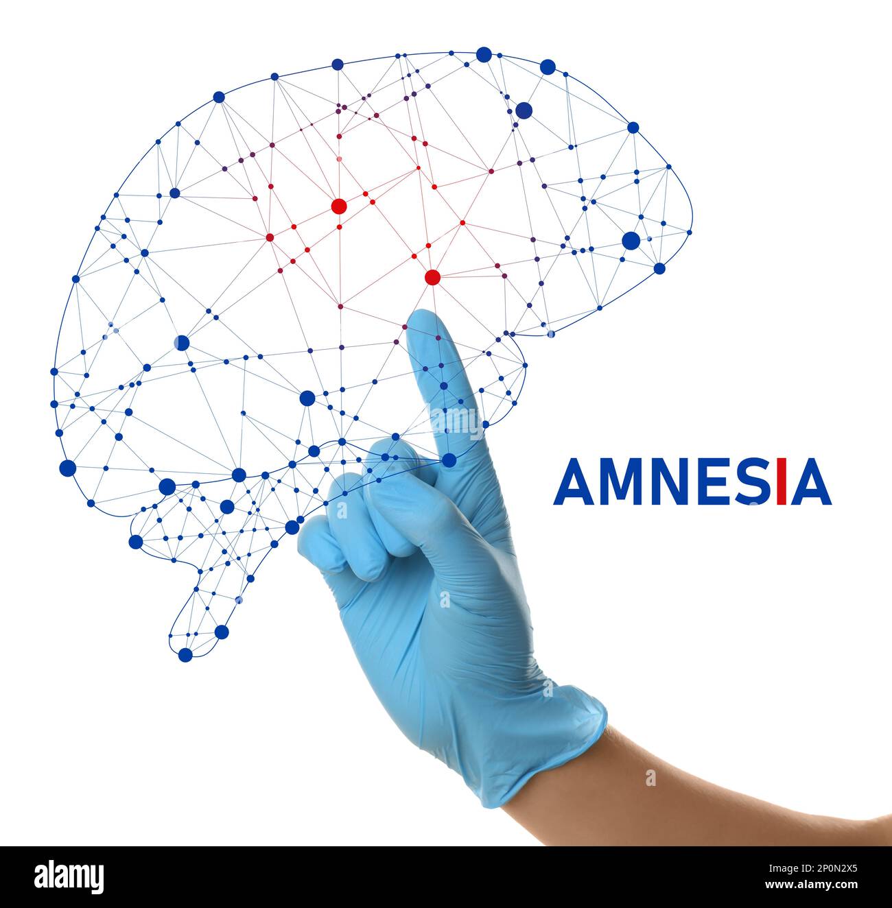 Amnesia therapy. Doctor in blue latex gloves pointing at human brain ...