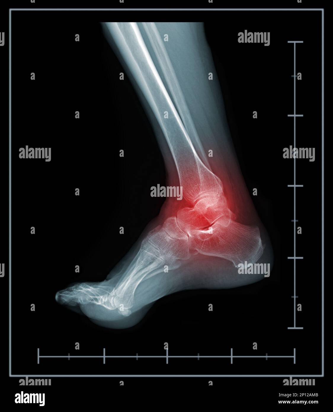 Metatarsal x ray hi-res stock photography and images - Alamy