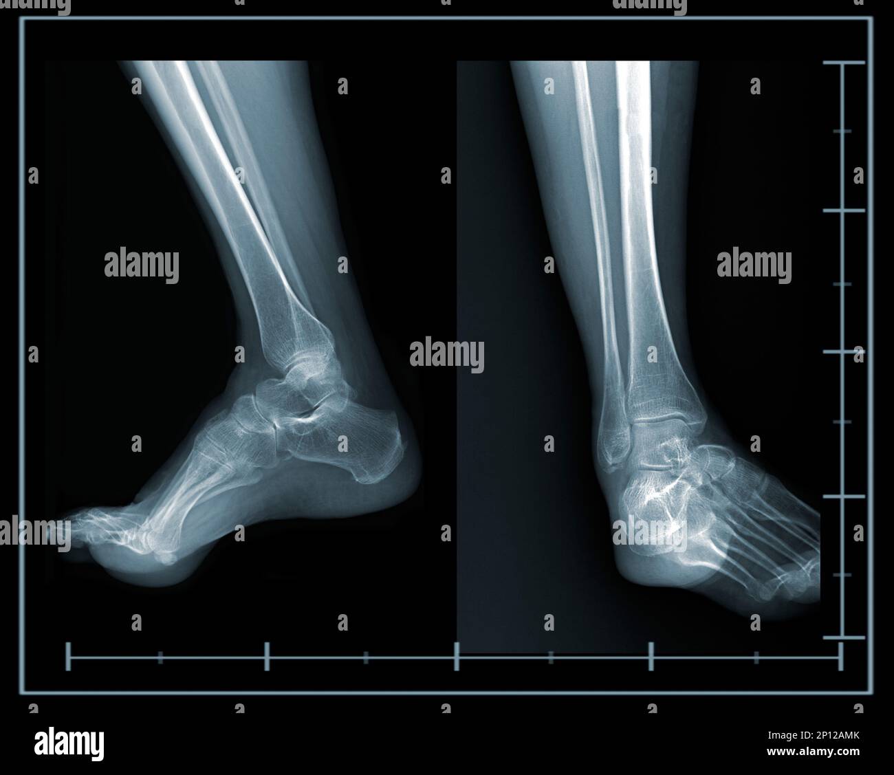 Normal ankle joint x ray hi-res stock photography and images - Alamy