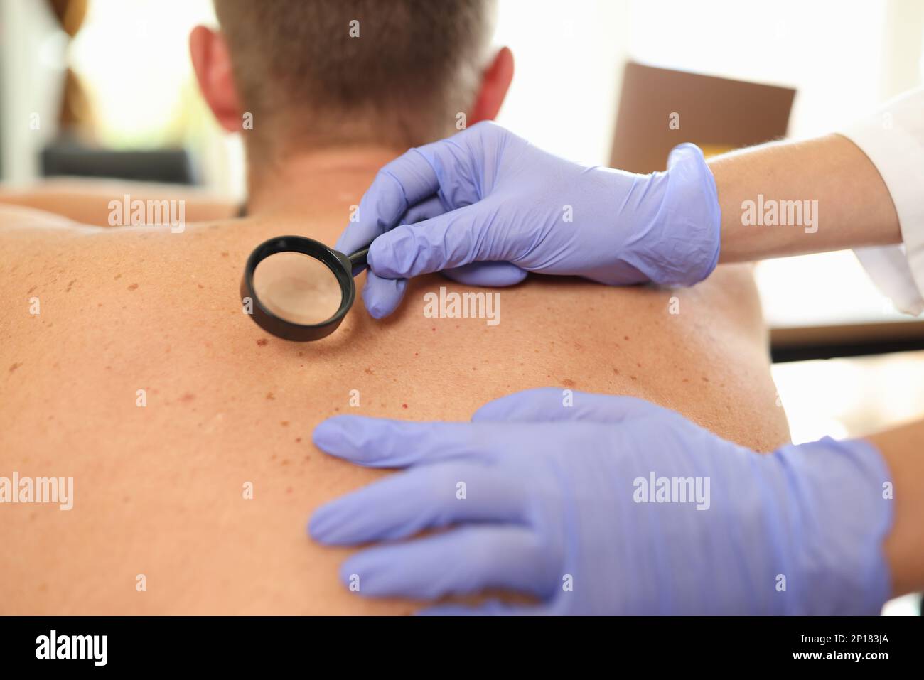 Doctor with magnifier examining pigmentation on male patient back Stock ...