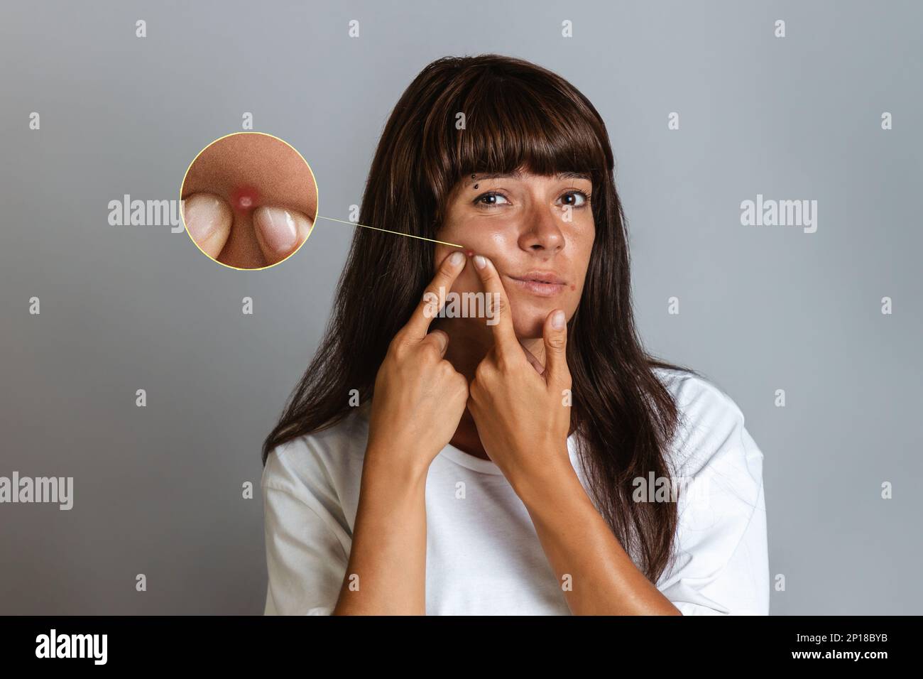 Acne and cosmetology. A tanned young woman squeezes a pimple on her ...