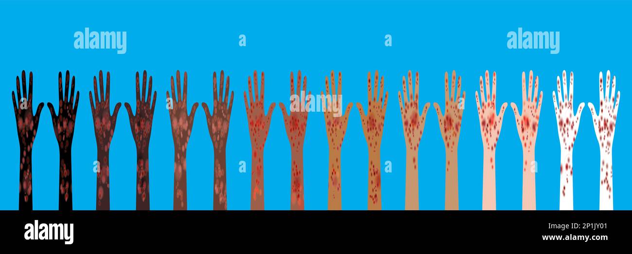 Painful rash on hands with different skin tones. Raised hands as if ...