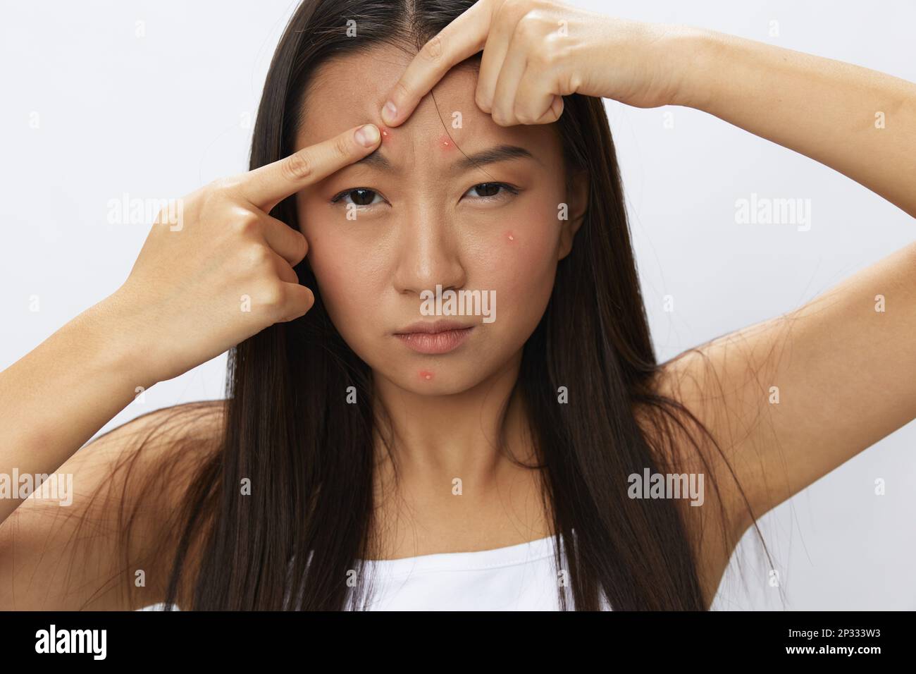 Asian woman facial skin problems, acne and inflammation, red rashes and ...