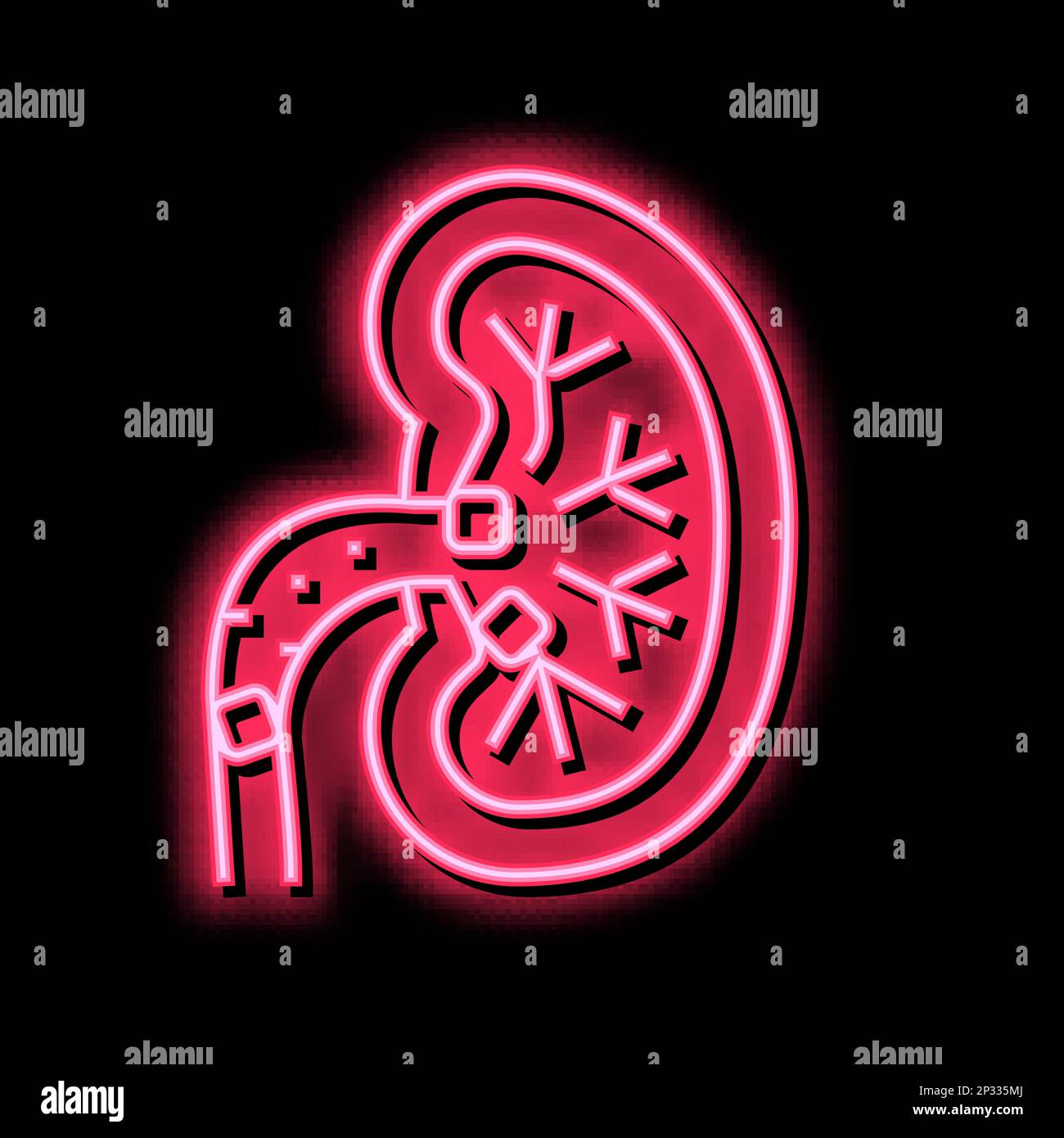 kidney stones neon glow icon illustration Stock Vector Image & Art - Alamy