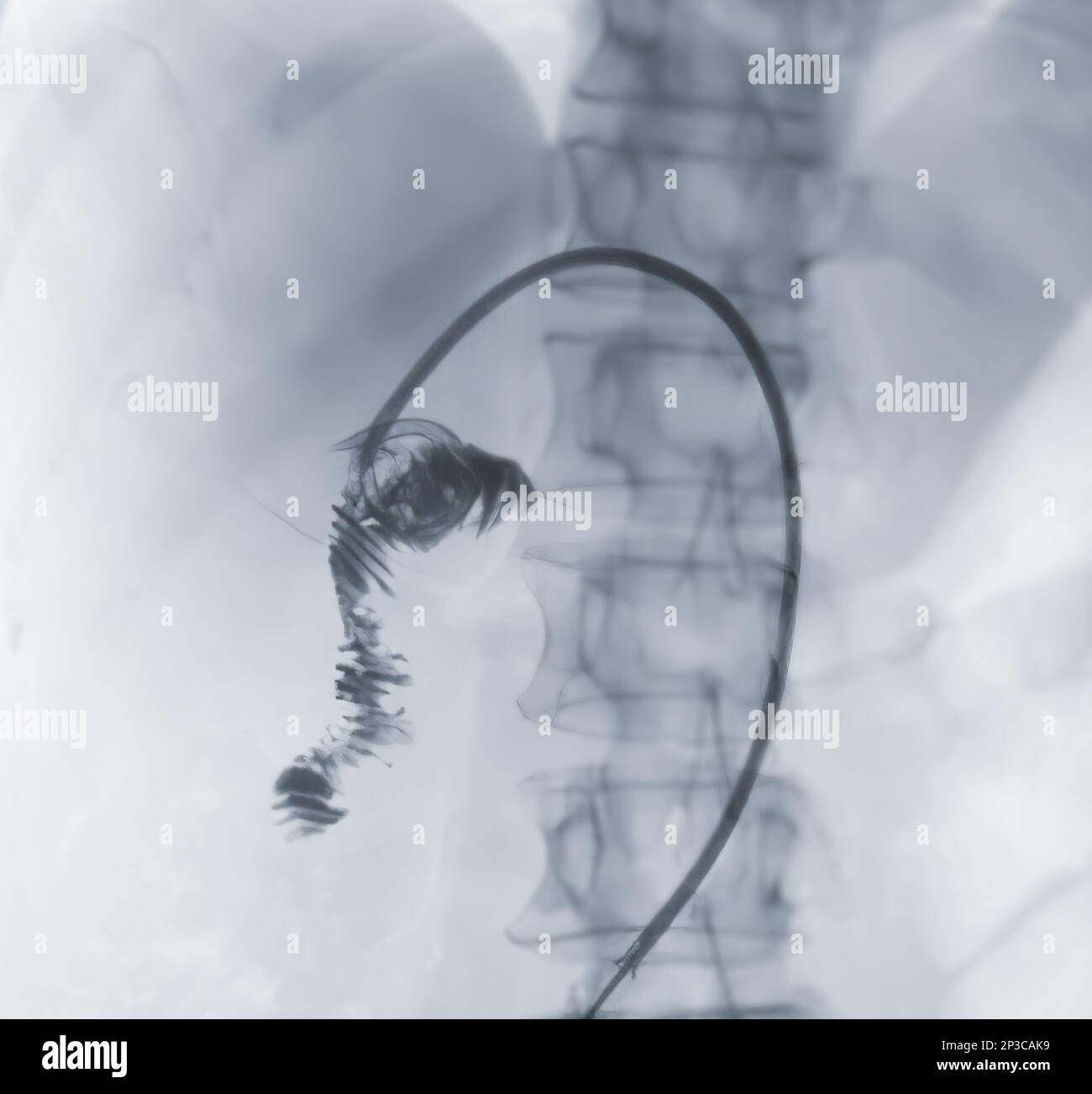 X-ray image of portal vein after Doctor doing ERCP and laparoscopic ...