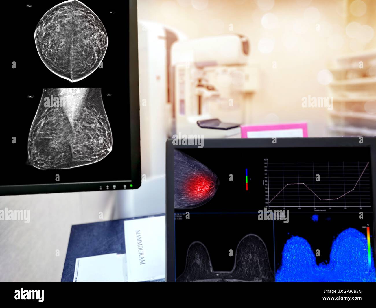 Mammography machine with monitor for breast screening device on ...