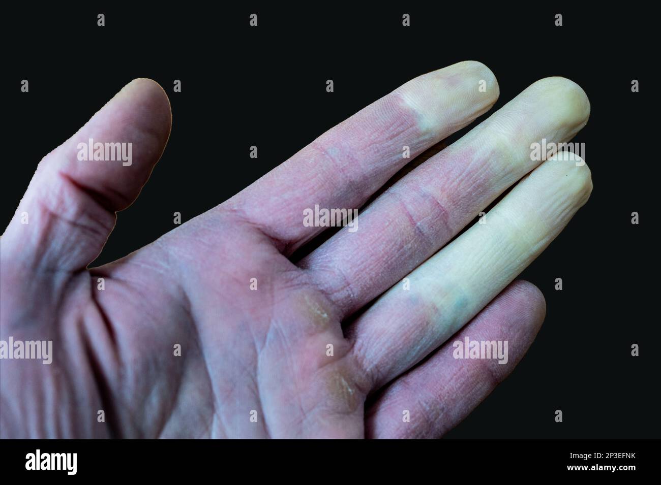 A frostbitten male hand with Raynaud's syndrome, Raynaud's phenomenon ...