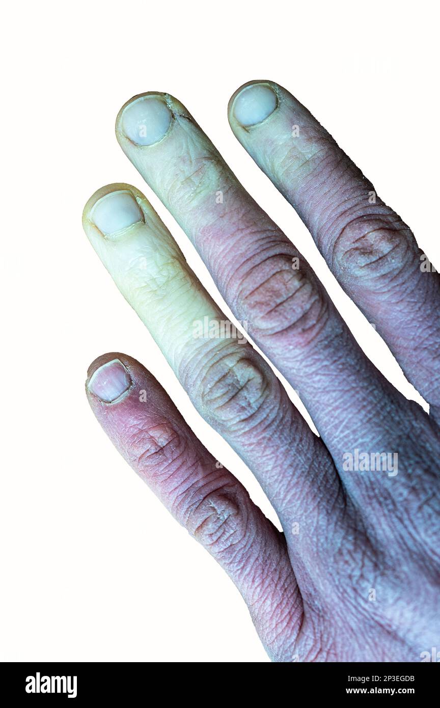 A frostbitten male hand with Raynaud's syndrome, Raynaud's phenomenon ...