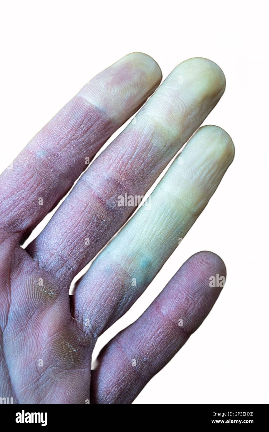 A frostbitten male hand with Raynaud's syndrome, Raynaud's phenomenon ...