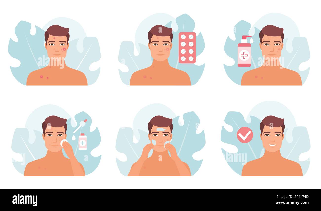Acne treatment infographic vector illustration set. Cartoon man ...