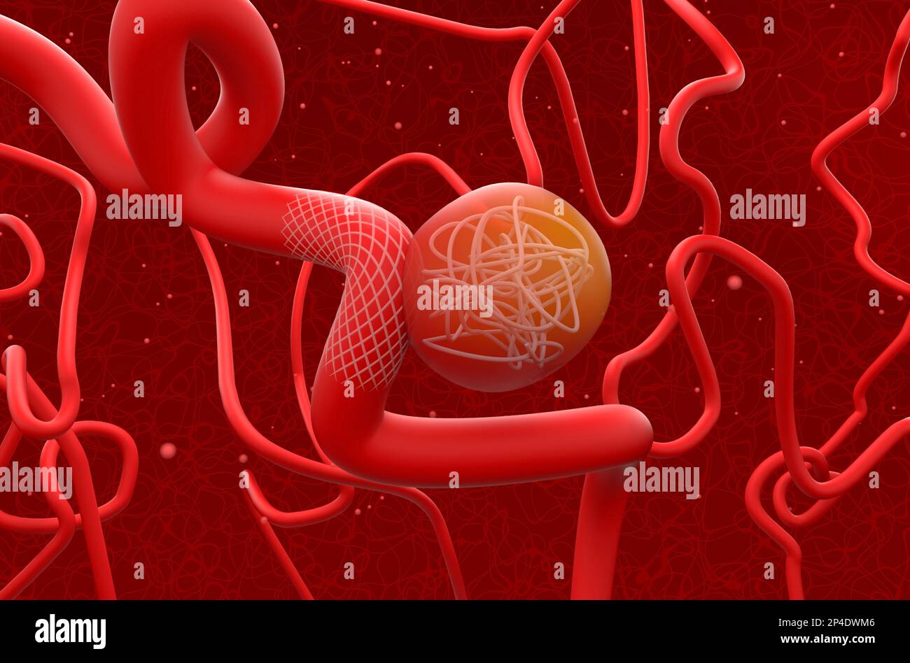 Abdominal aortic aneurysm hi-res stock photography and images - Alamy