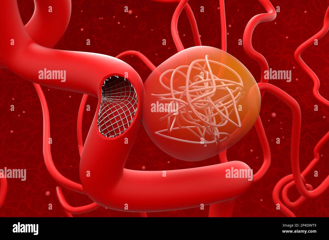 Aneurysm treat with mesh stent and coils (section) - 3d illustration ...