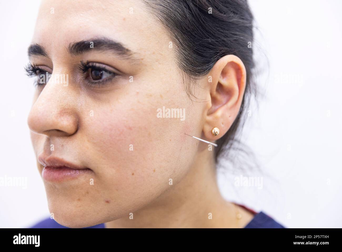 Dry needle treatment. A portrait of a small acupuncture needle sticking ...
