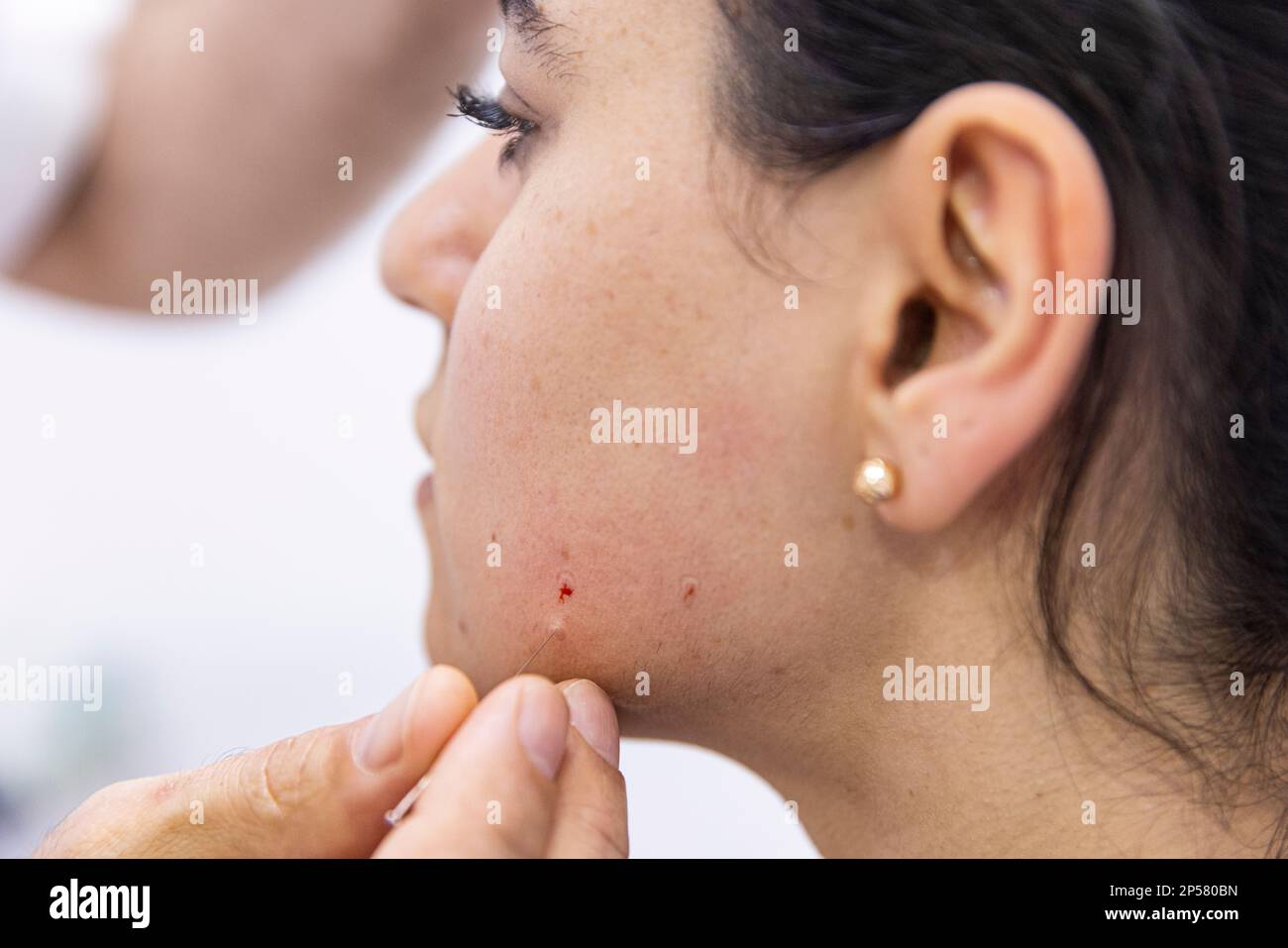 Dry needle treatment. A portrait of a small acupuncture needle sticking ...