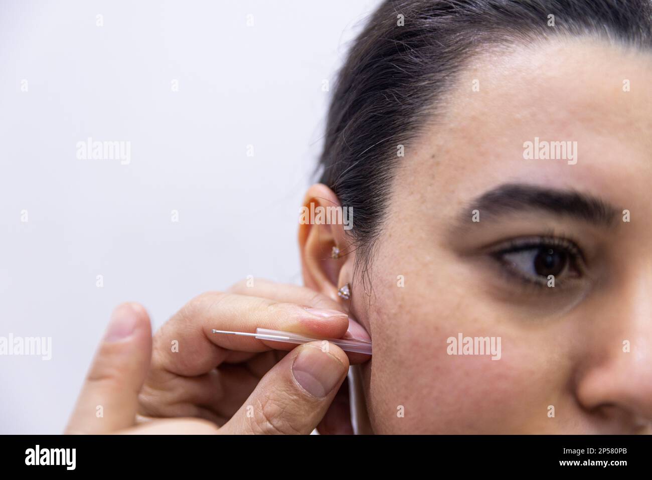 Dry needle treatment. A portrait of a small acupuncture needle sticking ...
