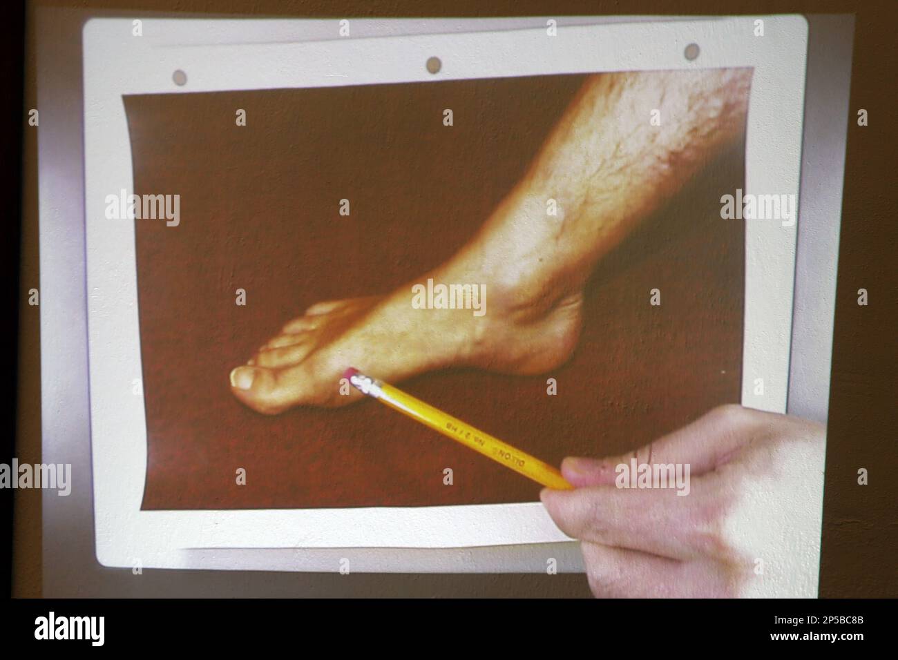 Brett T. Seacat points to burn marks on photos of his feet as he ...