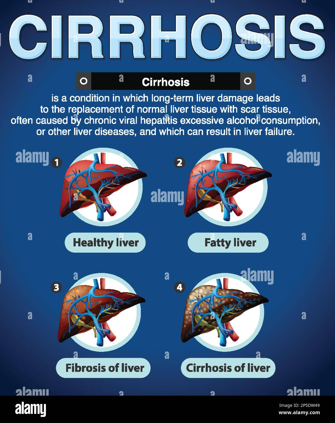 Stages of Liver Damage Infographic illustration Stock Vector Image ...