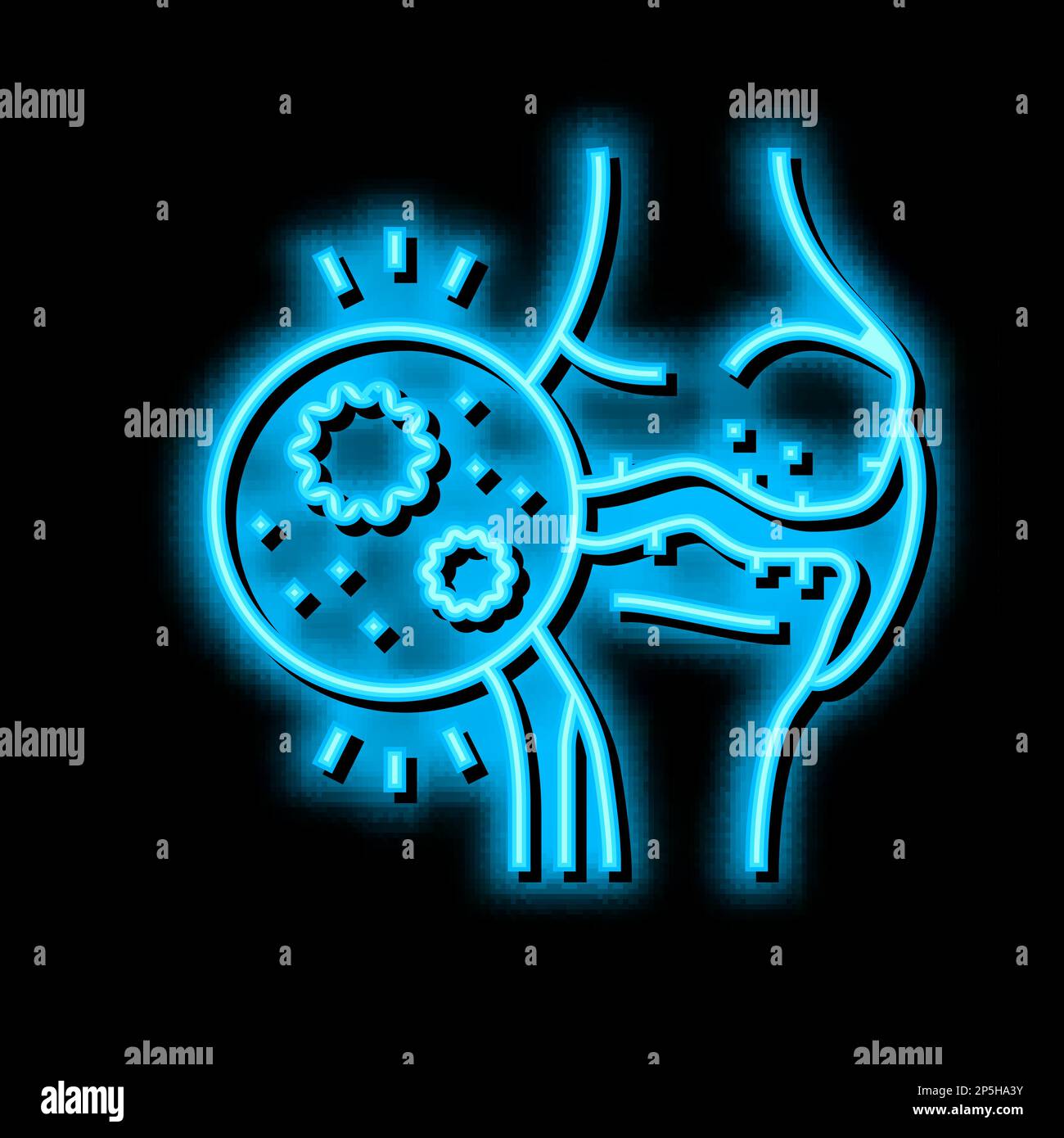 infectious arthritis neon glow icon illustration Stock Vector Image ...