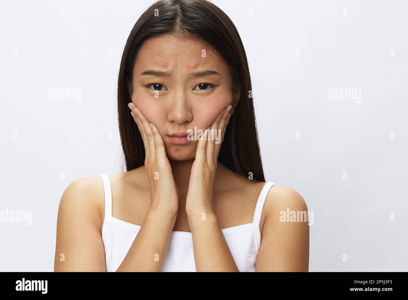 Asian woman facial skin problems, acne and inflammation, red rashes and ...