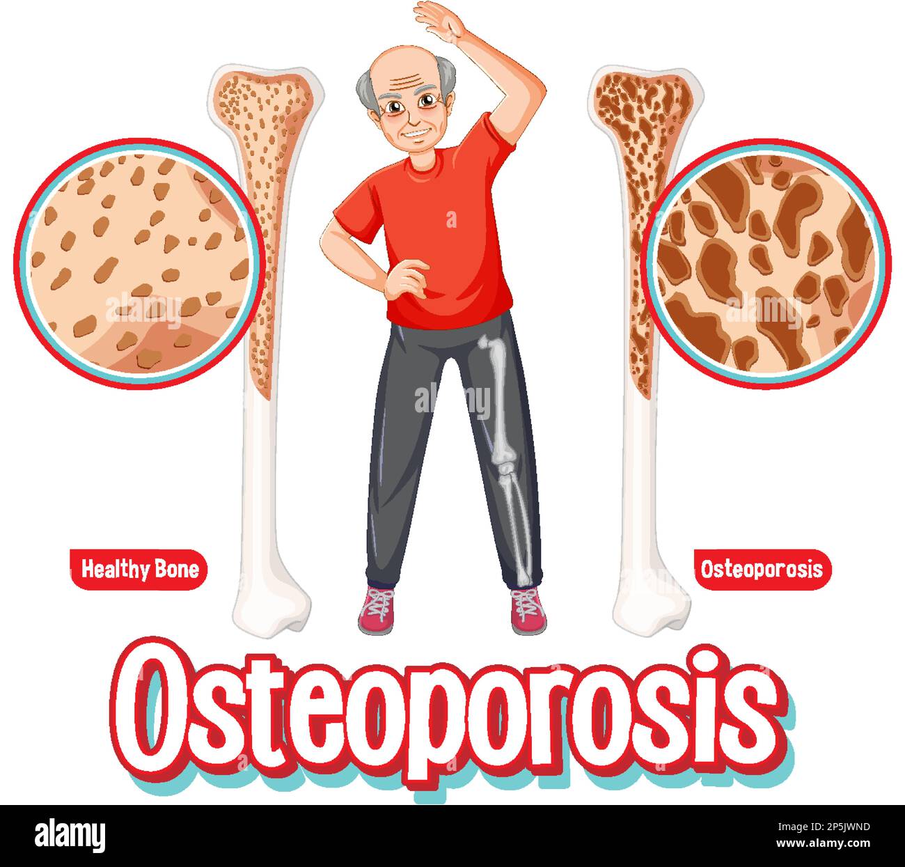 Comparison of normal bone and bone with Osteoporosis in old people ...