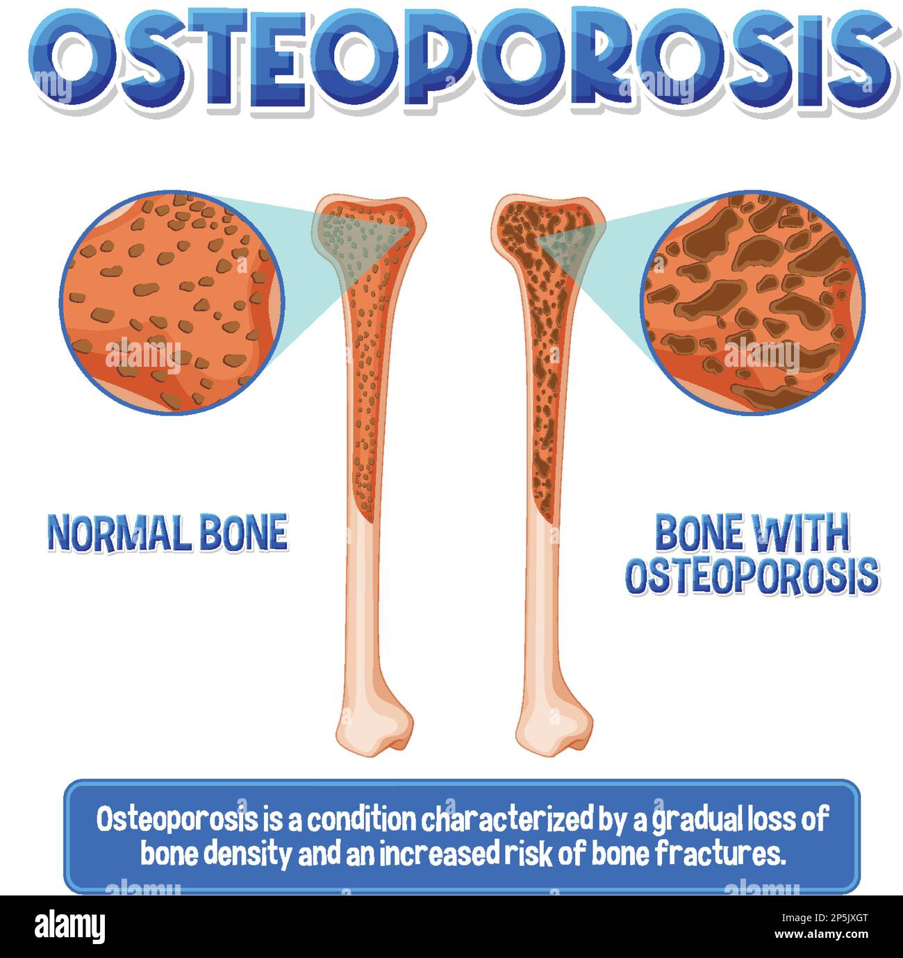 Informative poster of Osteoporosis human bone illustration Stock Vector ...