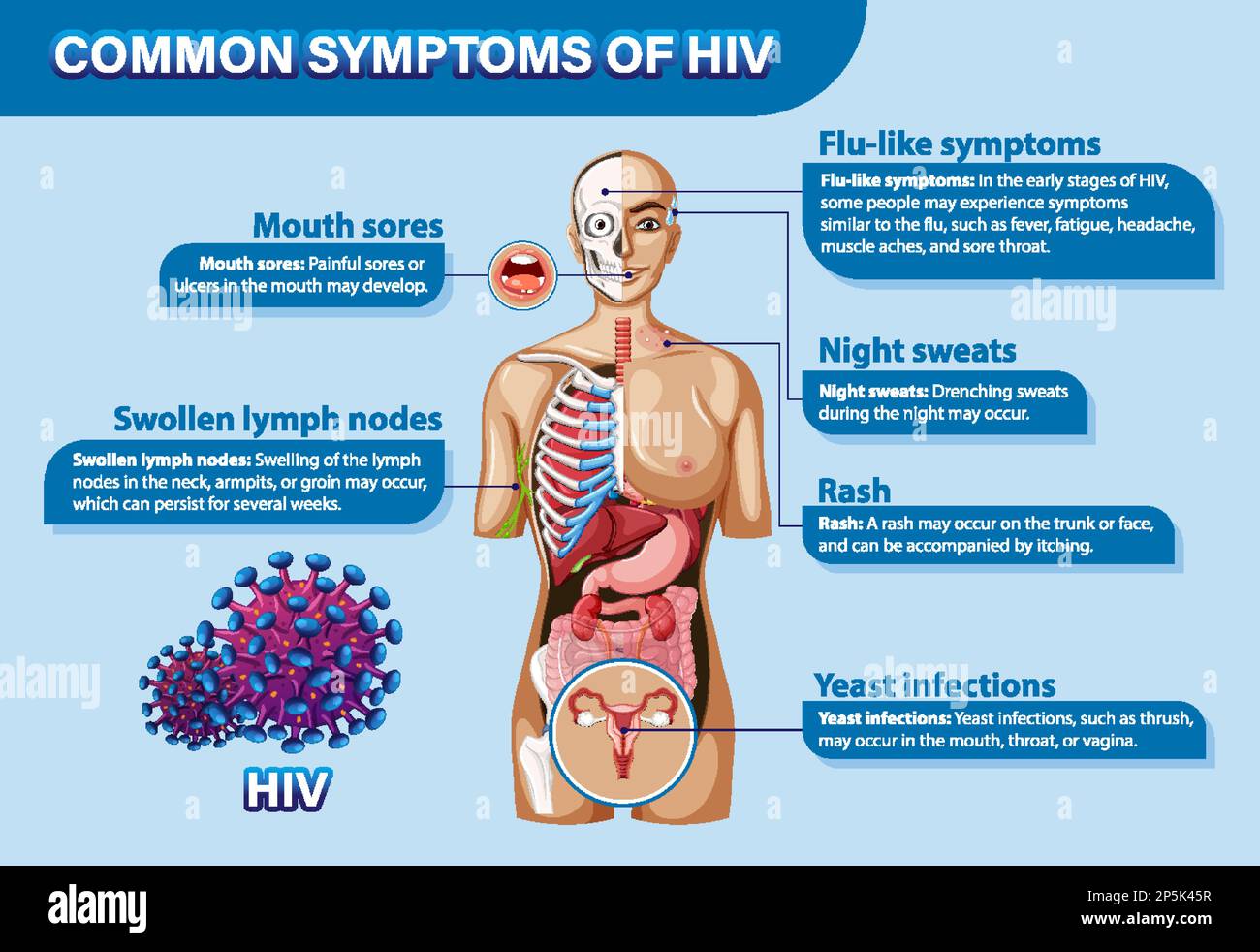 Informative Poster Of Common Symptoms Of Hiv Illustration Stock Vector