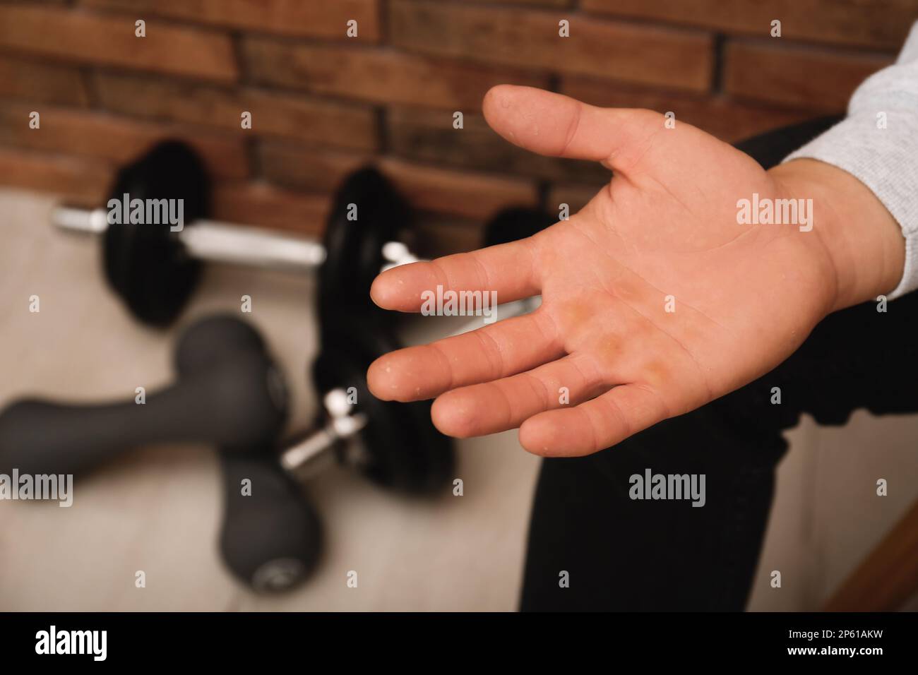 Man suffering from calluses on hand indoors, closeup Stock Photo - Alamy