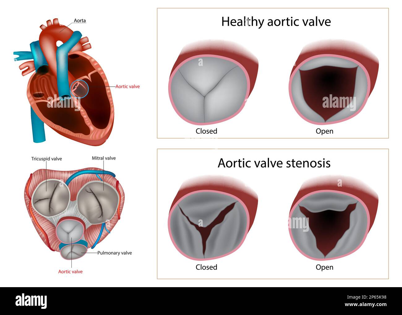Aortic Valve Stenosis – eroppa Aortic Valve Stenosis – eroppa