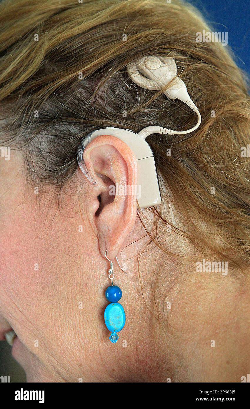 A cochlear implant is an implanted electronic hearing device designed ...