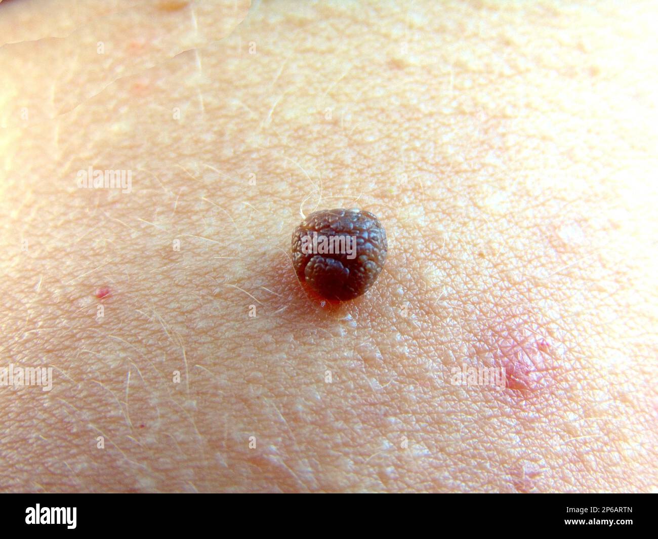papilloma on a person's skin Stock Photo - Alamy