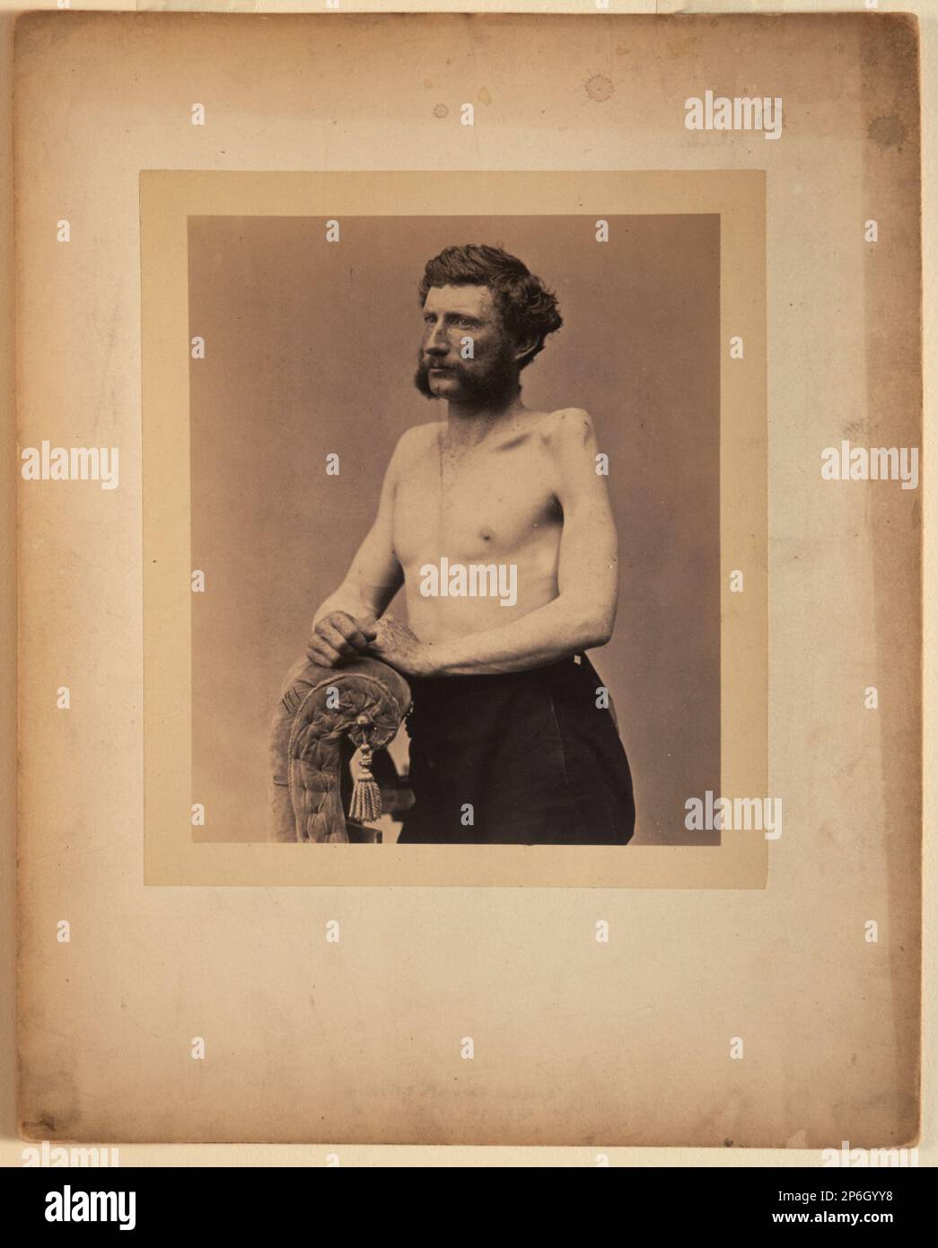 William H. Bell, Wounded Officer (Successful Secondary Excision of the ...