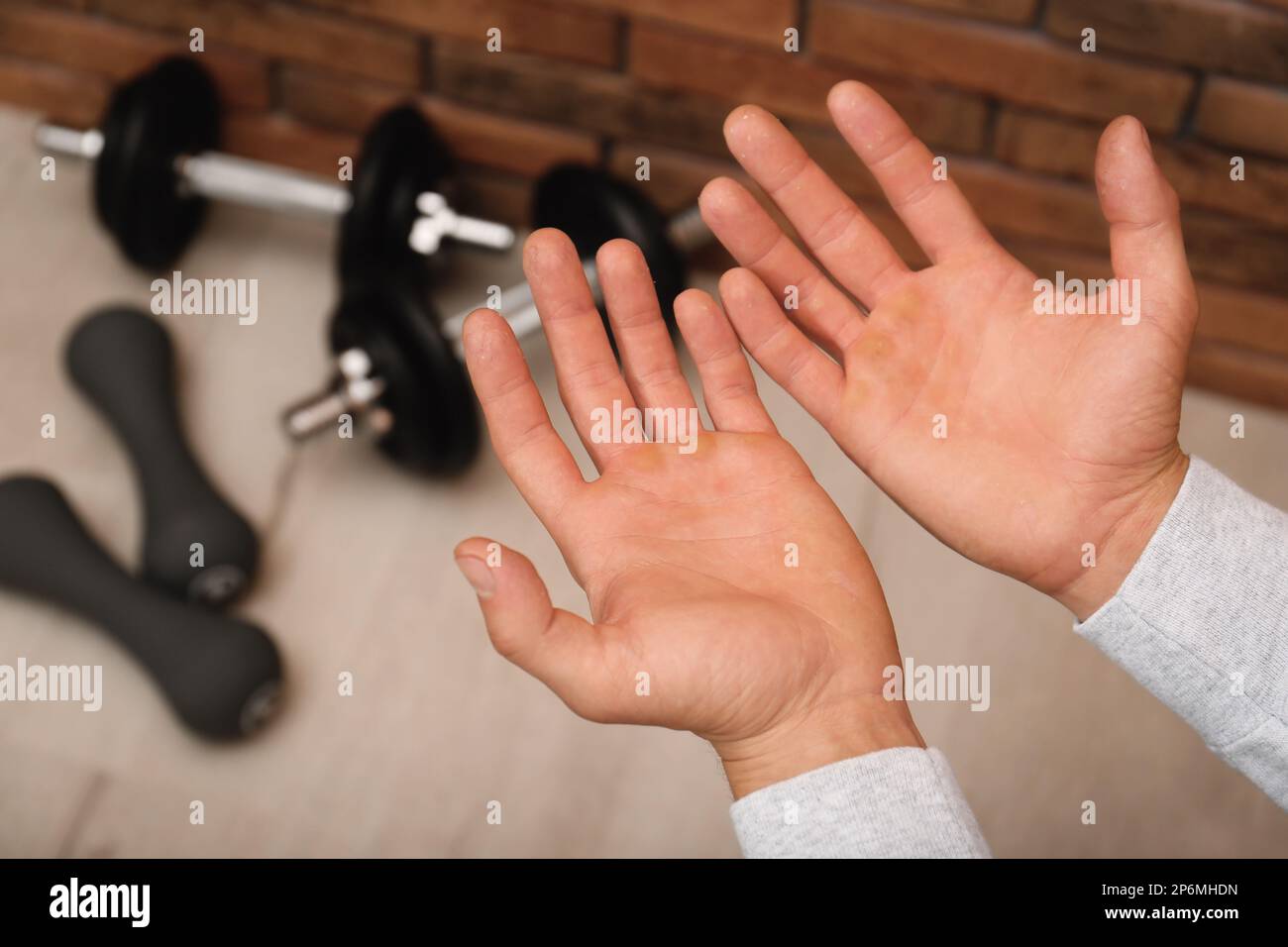 Man suffering from calluses on hands indoors, closeup Stock Photo - Alamy