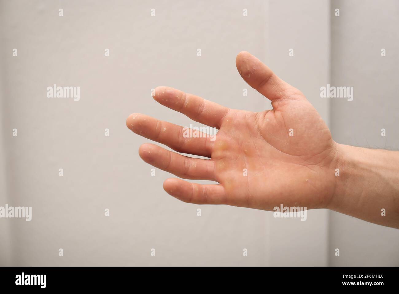 Calluses hi-res stock photography and images - Alamy