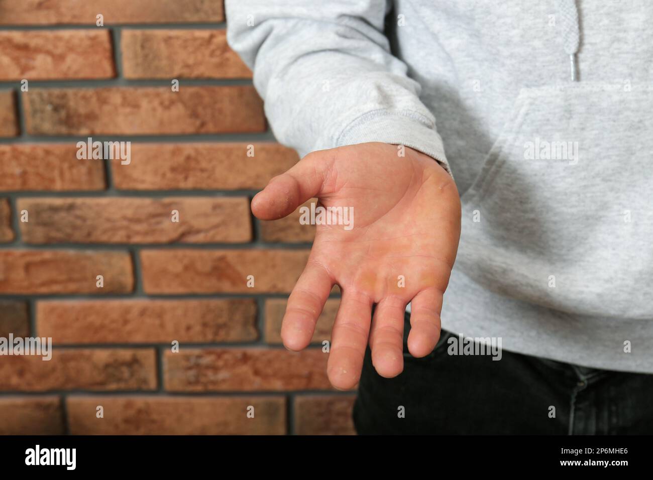 Man suffering from calluses on hand near brick wall, closeup Stock ...
