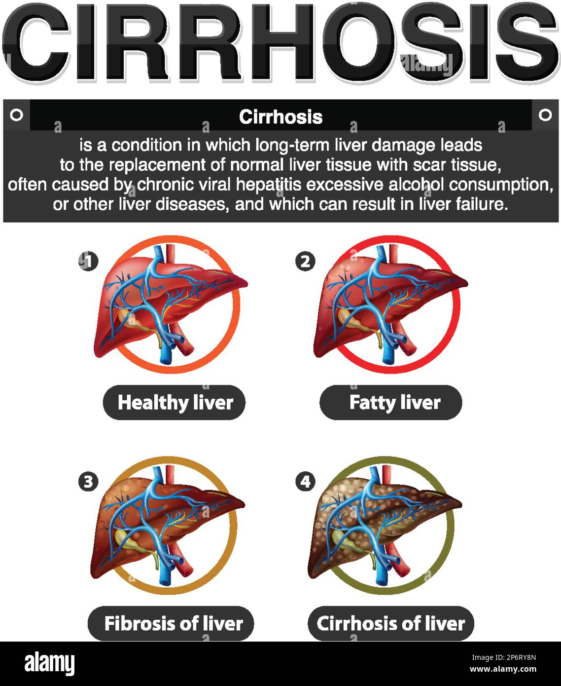 Stages of Liver Damage Infographic illustration Stock Vector Image ... Stages of Liver Damage Infographic illustration Stock Vector Image ...