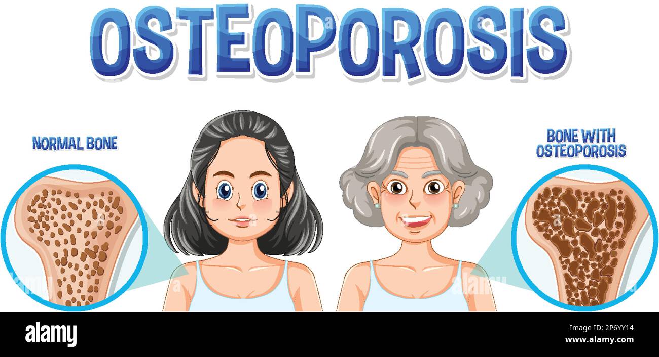 Comparison of normal bone and bone with Osteoporosis in old people ...