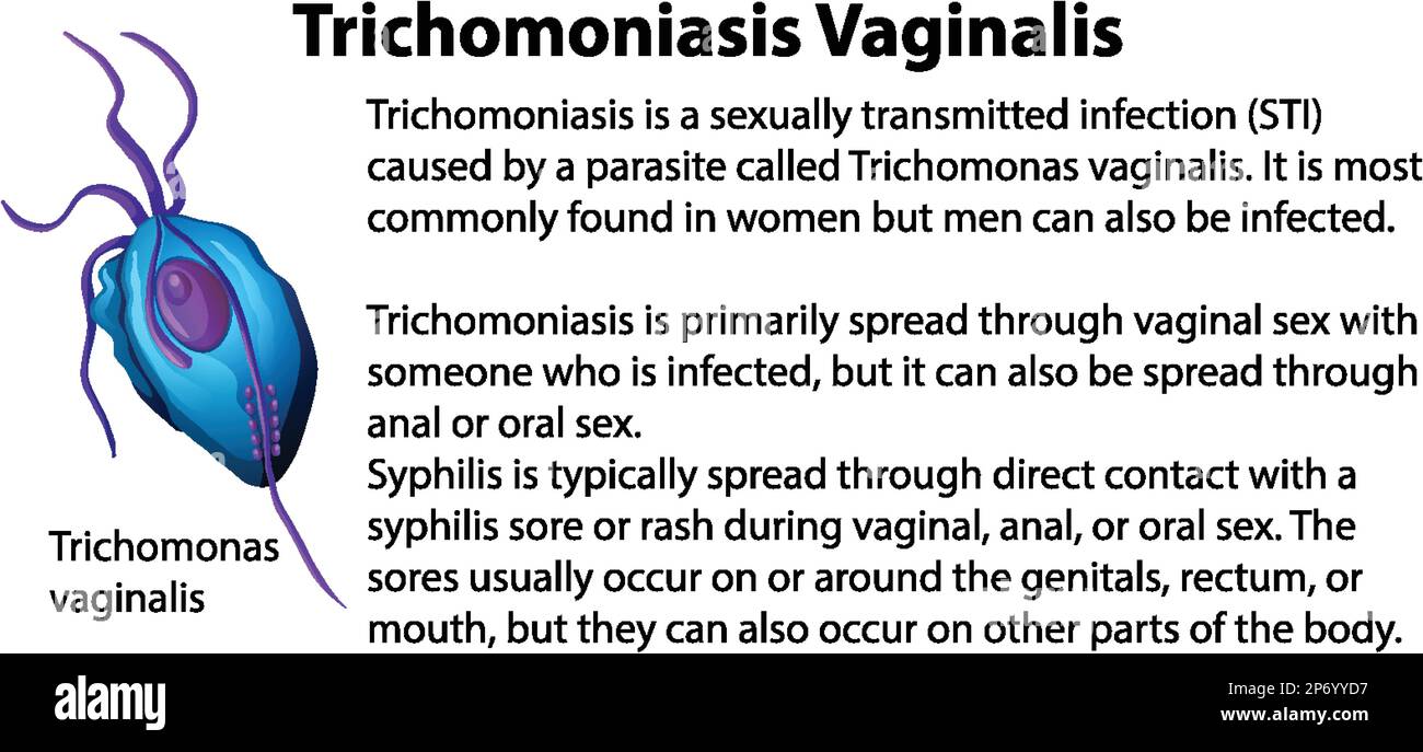 Trichomoniasis Vaginalis with explanation illustration Stock Vector ...