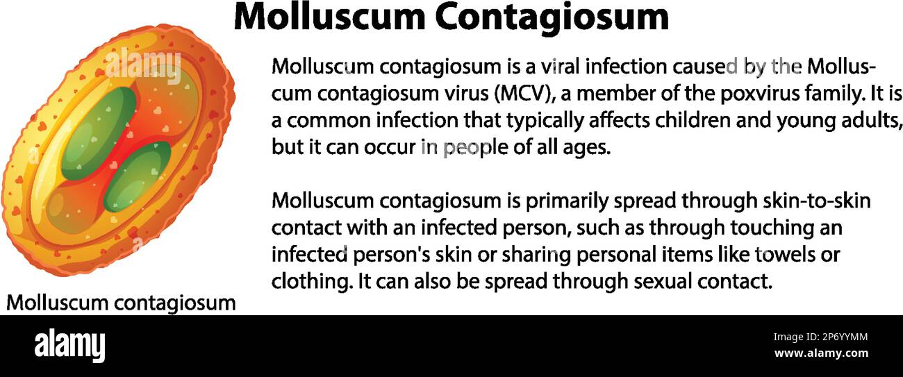 Molluscum Contagiosum with explanation illustration Stock Vector Image ...