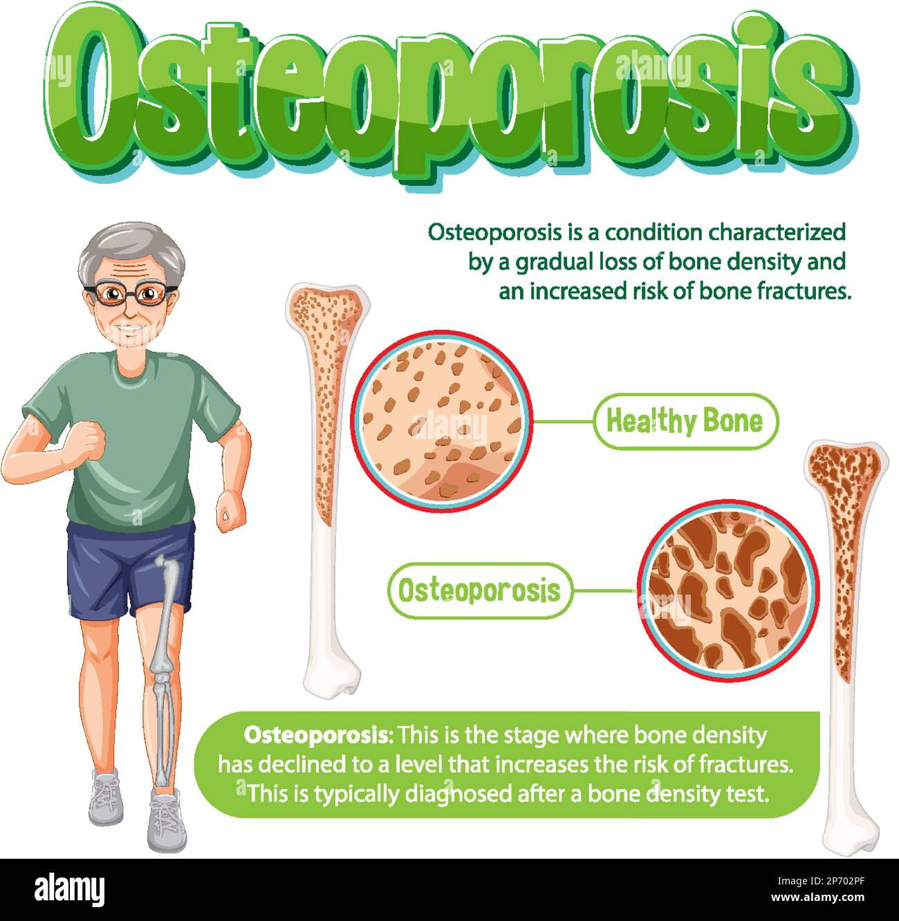 Informative poster of Osteoporosis human bone illustration Stock Vector ...