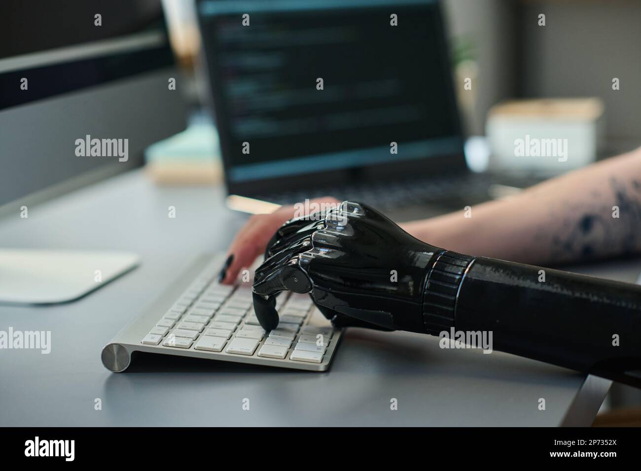 Close-up of girl with prosthetic arm typing on keyboard, she using ...