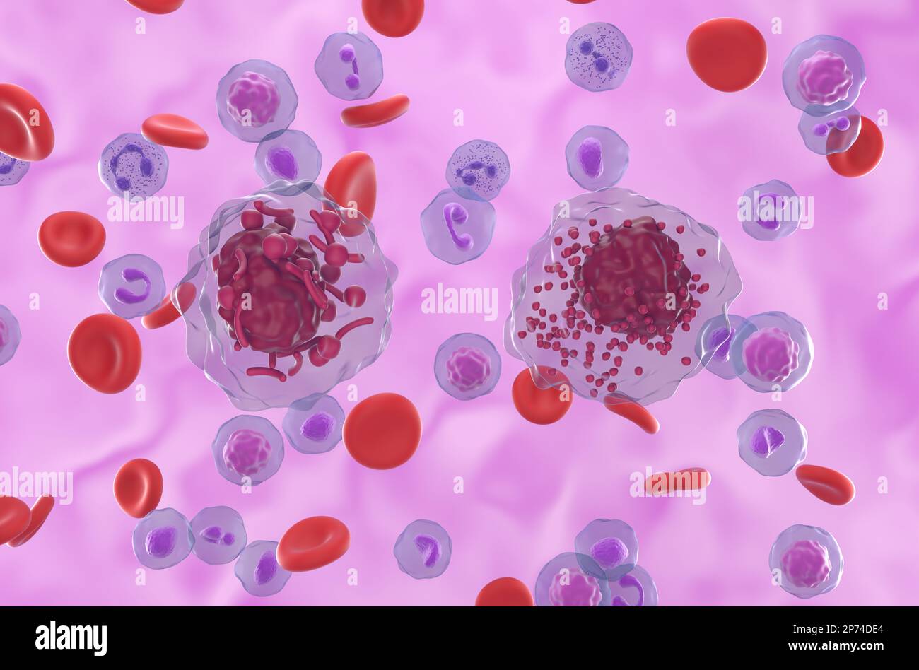 Auer rods (or Auer bodies) in acute Hypergranular Promyelocytic ...