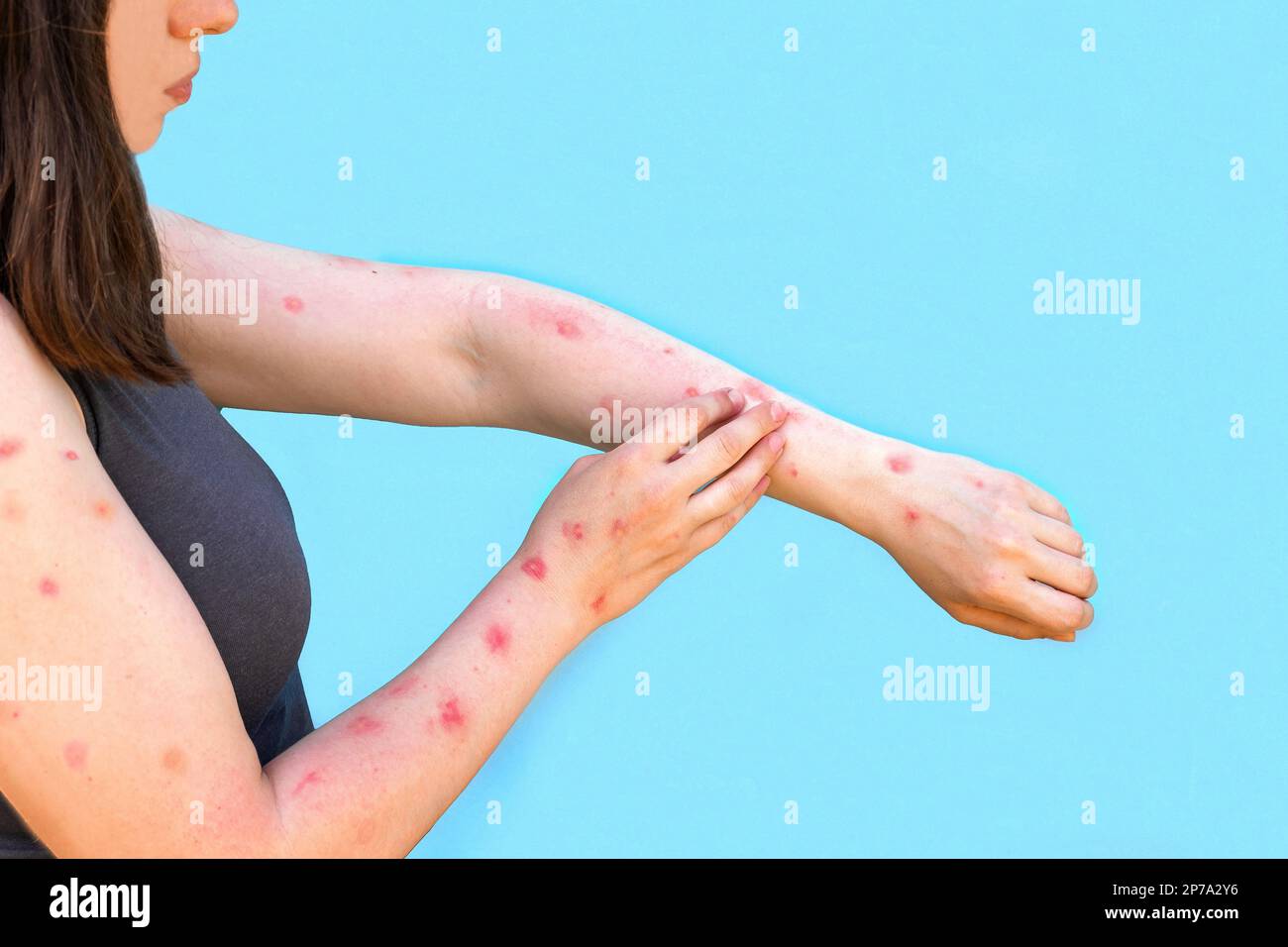 Monkeypox new disease dangerous over the world. Patient with Monkey Pox ...