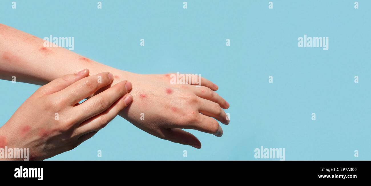 Monkeypox new disease dangerous over the world. Patient with Monkey Pox ...