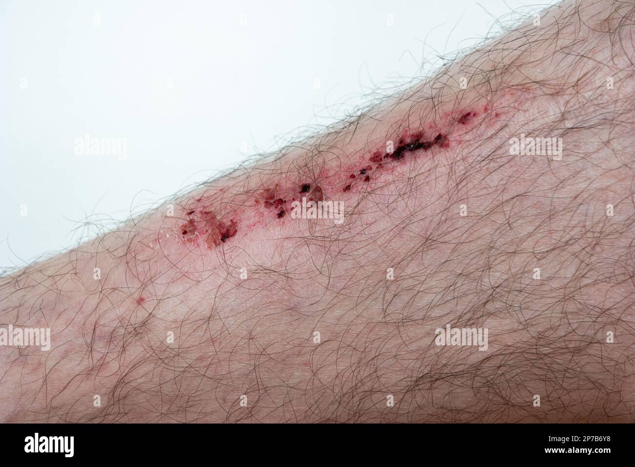 Bruised skin macro close up shot of hairy Caucasian male leg Stock ...