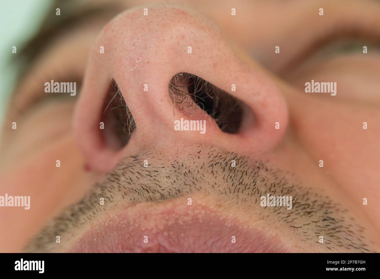 Caucasian male unkempt nose hair follicles macro close up shot. Close ... Caucasian male unkempt nose hair follicles macro close up shot. Close ...