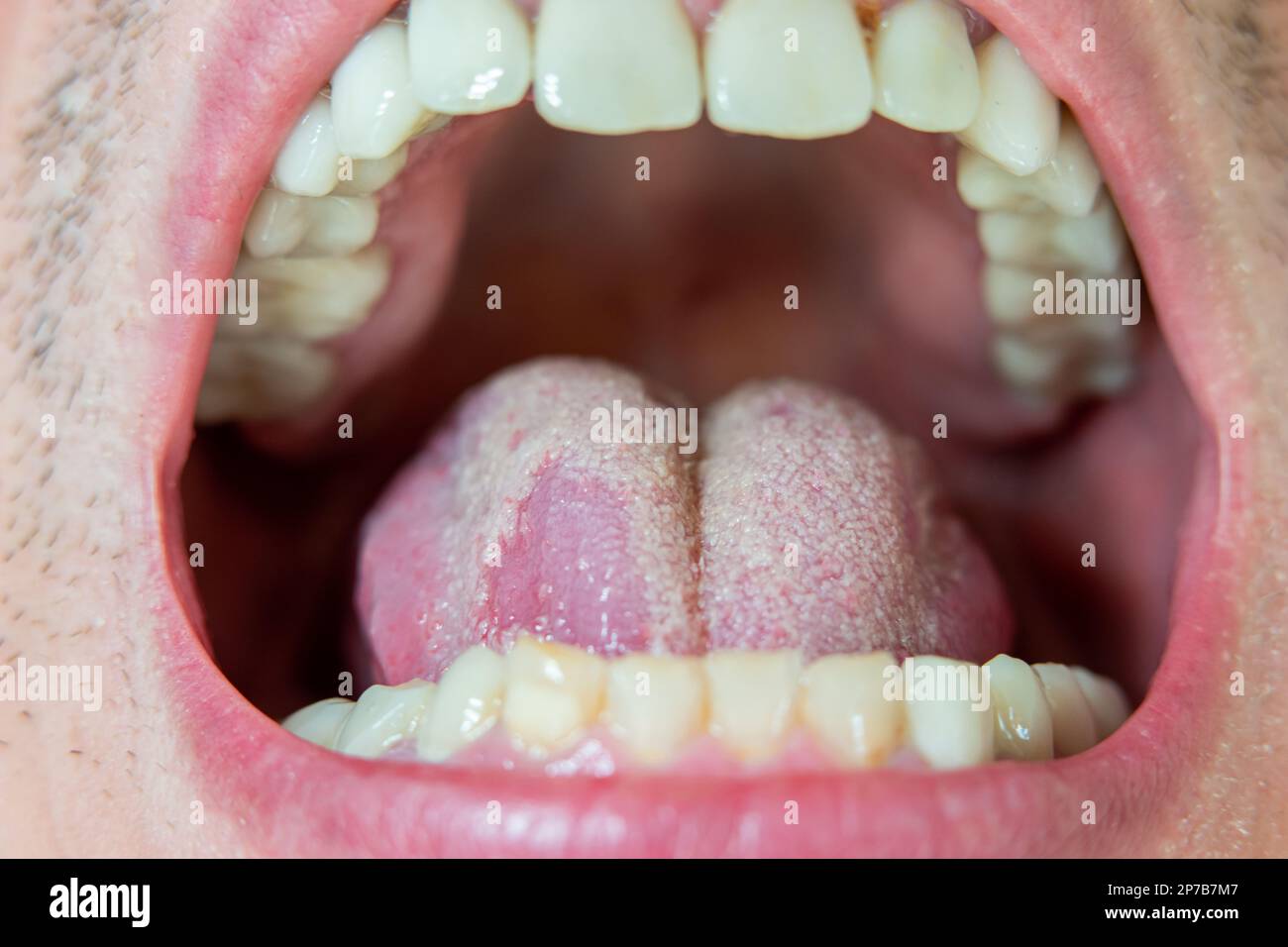 Caucasian male tongue with yeast infection candida. Macro close up shot ...