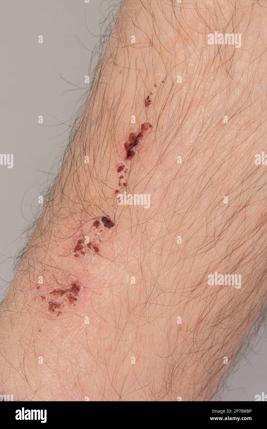 Bruised skin macro close up shot of hairy Caucasian male leg Stock ... Bruised skin macro close up shot of hairy Caucasian male leg Stock ...