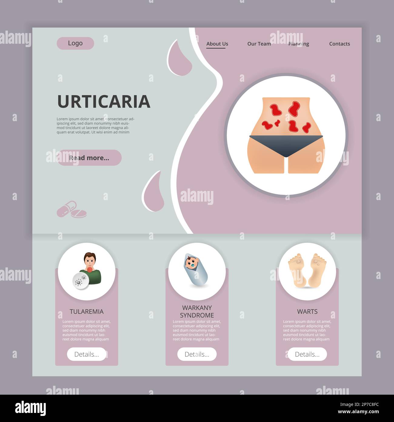 Urticaria flat landing page website template. Tularemia, warkany ...