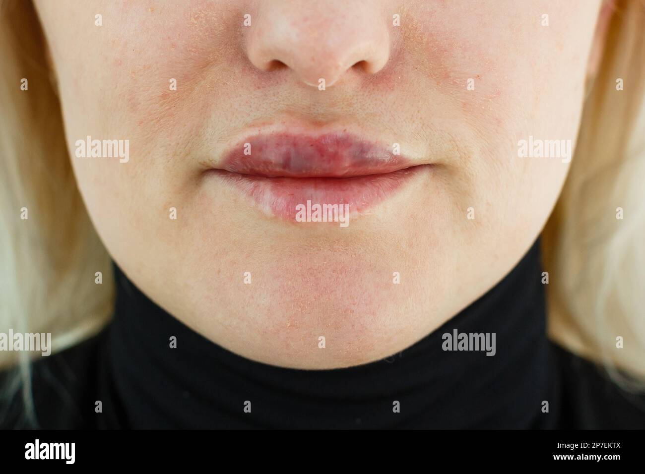 woman asymmetric lips as a result after lip augmentation with ...